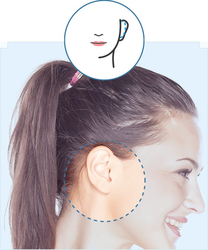 Otoplastia, Cirugía de Orejas - Doctor Javier Rodrigo